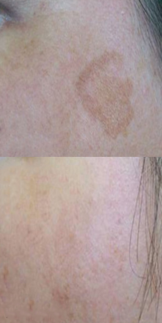 Paramedical - Scar Camouflage | Fabulously Flawless Permanent Cosmetics