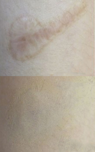 Paramedical - Scar Camouflage | Fabulously Flawless Permanent Cosmetics